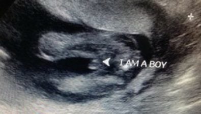 What To Expect When You're 18 Weeks Pregnant | MomTricks