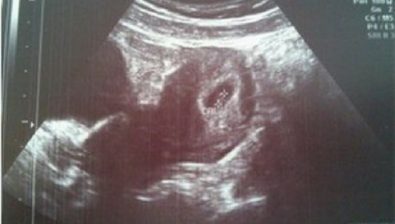 What To Expect When You're 6 Weeks Pregnant | MomTricks